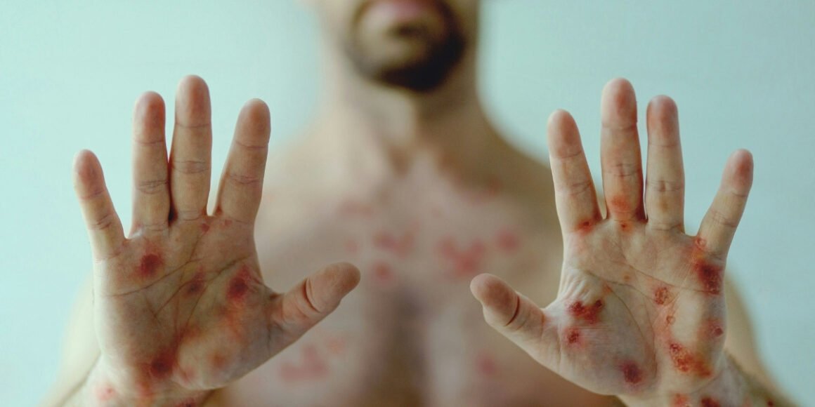 How to Treat Ringworm Fast: Essential Tips and Home Remedies - Atlanta Wire